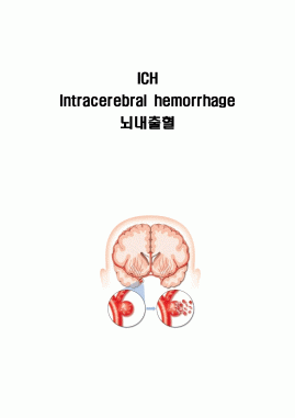 ICH Intracerebral hemorrhage 뇌내출혈 케이스, ICH 케이스 스터디, ICH 간호과정, 뇌내출혈 케이스, 뇌내출혈 간호과정,-1페이지