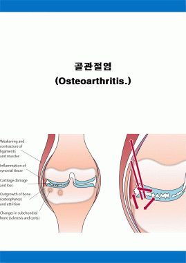 골관절염, 골관절염 case study, osteoarthritis 간호과정-1페이지