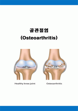 골관절염 (Osteoarthritis) TKR - # Osteoarthritis 케이스, 골관절염 케이스, 골관절염 간호과정, TKR 간호과정, TKR 수술, TKR 케이스 스터디, Osteoarthritis 간호과정)-1페이지