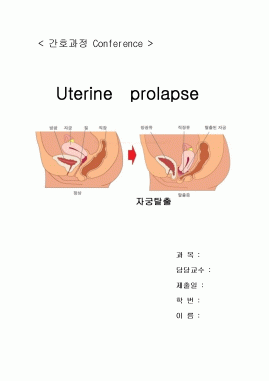 자궁탈출 uterine prolapse 간호진단  간호과정 모성 AA레포트-1페이지