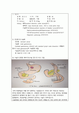 수술실 보고서. stomach cancer , total gastrectomy, 성인간호실습-1페이지