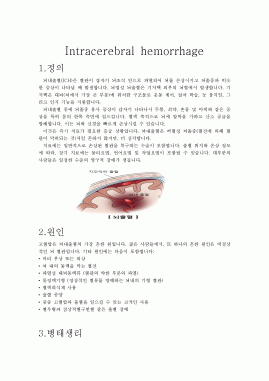 뇌내출혈(Intracerebral hemorrhage) 성인간호학 질환보고서-1페이지
