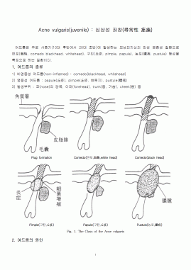 여드름 Acne vulgaris(juvenile) : 심상성 좌창(尋常性 痤瘡)-1페이지