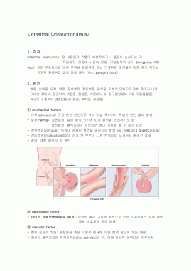 ileus 장폐색 레포트 자료-1페이지