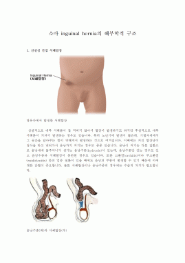소아 inguinal hernia의 해부학적 구조 -1페이지