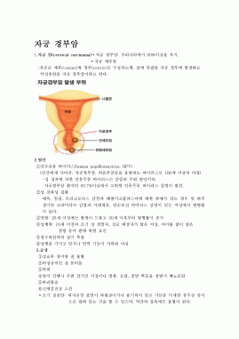 자궁 경부암 레포트 자료-1페이지