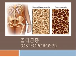 골다공증. (Osteoporosis)-1페이지