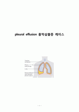 pleural effusion 흉막삼출증 케이스, 흉수 케이스, 흉막삼출증 간호과정, pleural effusion 케이스, 흉막삼출증 사례연구-1페이지