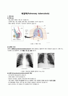 폐결핵 case, 성인간호학 실습,폐결핵 케이스,TB case-1페이지