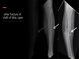 경골골절케이스 / other fracture of shaft of tibia, open / 근골격계 케이스-1페이지